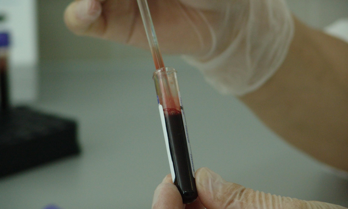 Cientistas desenvolvem exame que pode detectar 5 tipos de câncer ...